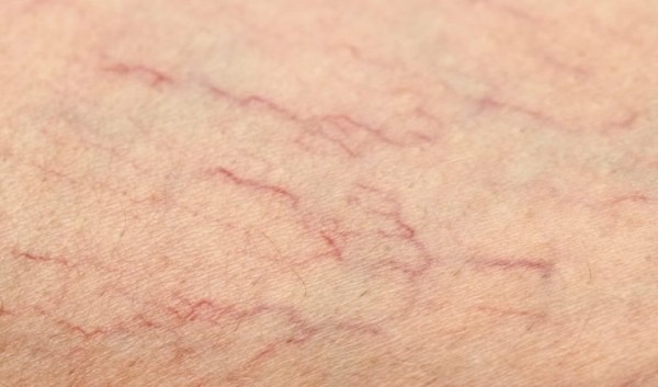 10 Causes of Broken Capillaries (Spider Veins)