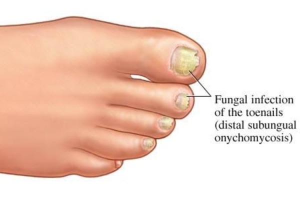 10 Best Food & Diet Meal Plan for Toenail Fungus