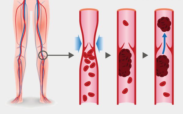 10 Best Food & Diet (Meal Plan) for Angina
