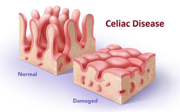 10 Best Food & Diet (Meal Plan) for C. Difficile Infection